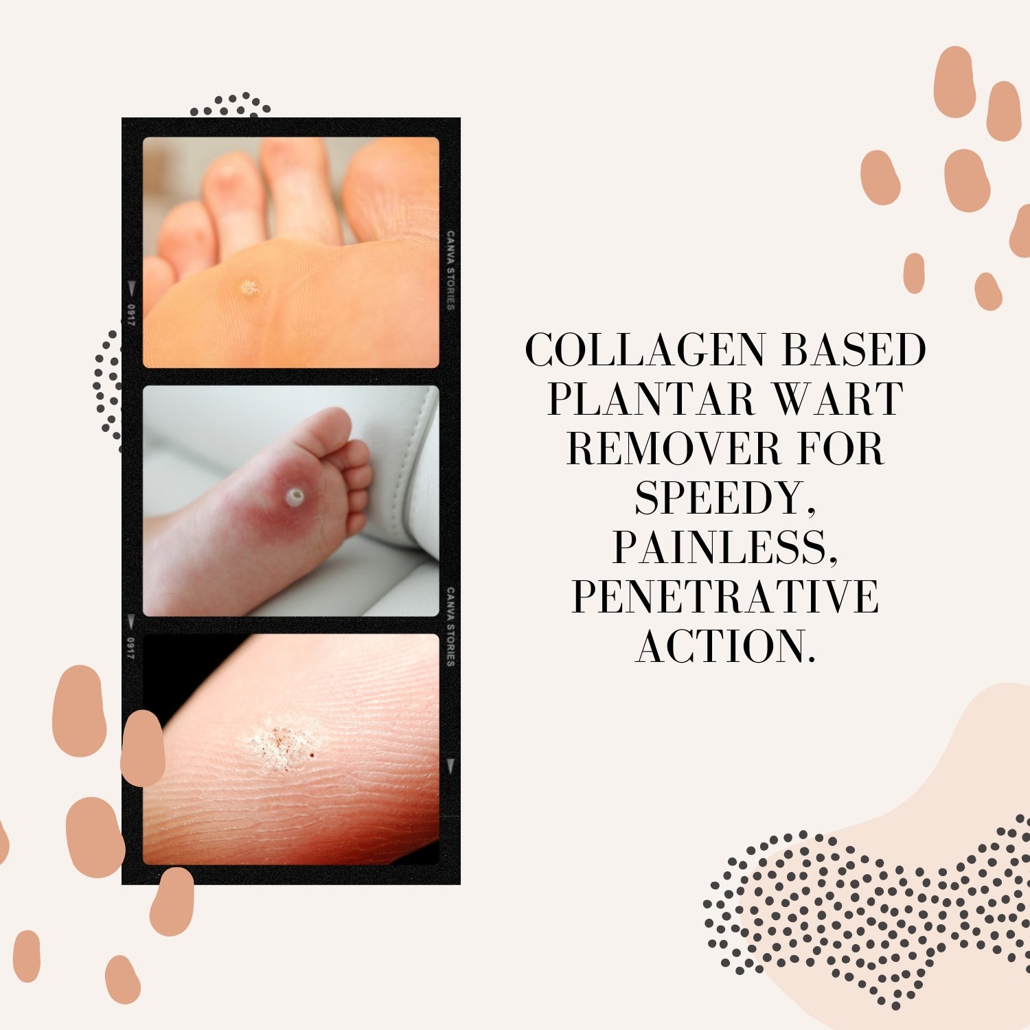 SALCOLL COLLAGEN Wart Remover, Plantar, Common, Stops Wart Regrowth 15 ...